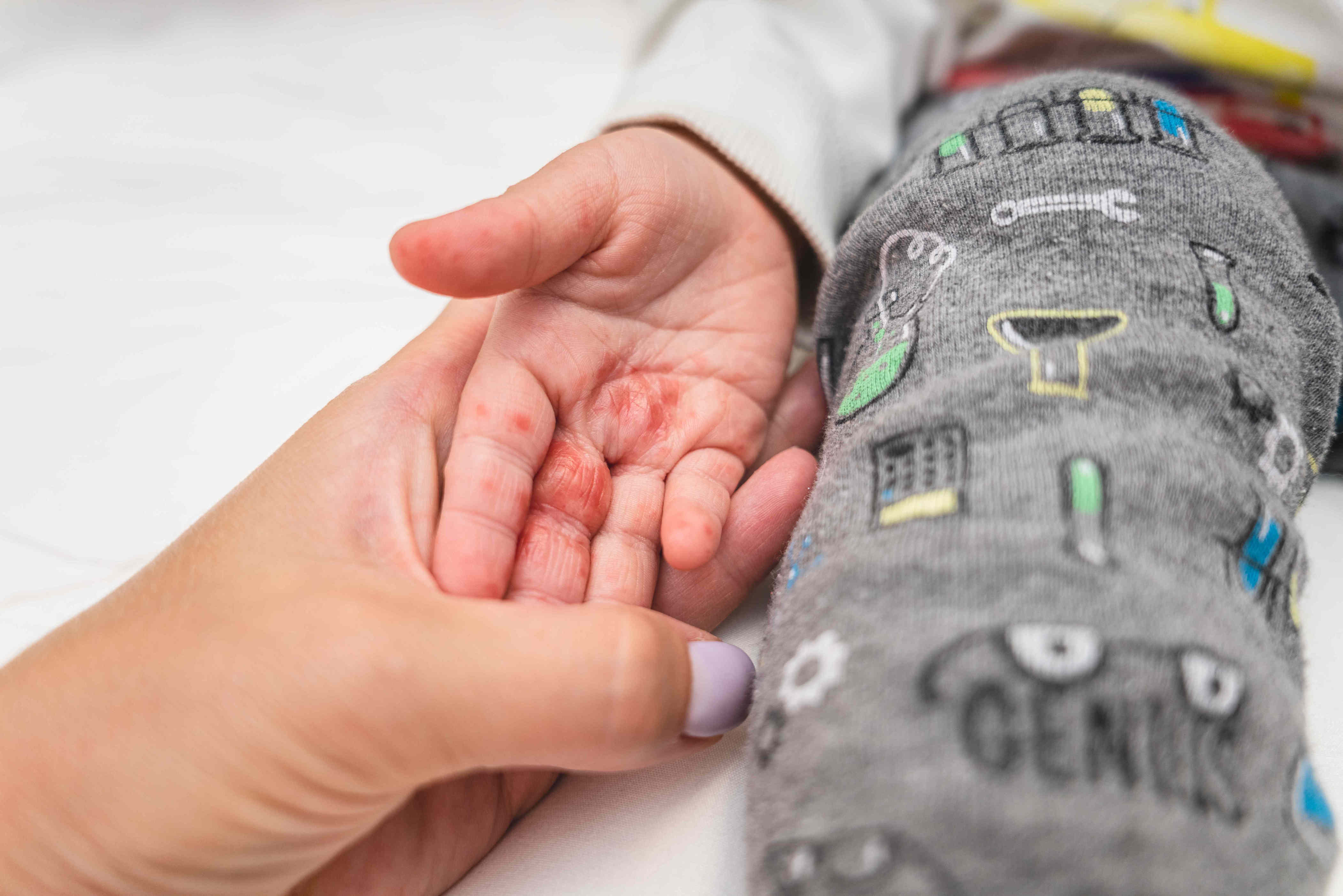 Hand, Foot, and Mouth Cases Are Spiking—Here’s What Parents Need to ...