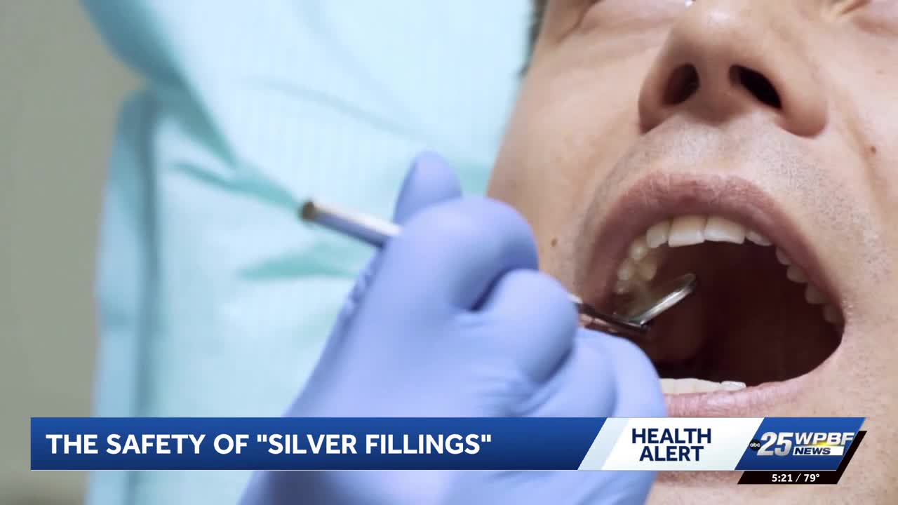 What to know about 'silver' dental amalgam fillings