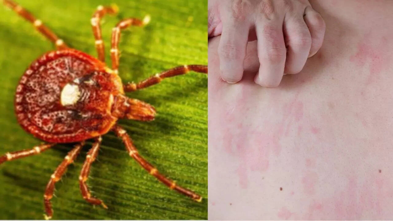 What is alpha-gal syndrome: Understanding how tick bites can turn red ...