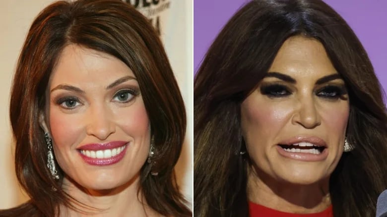 Trump Allies Embrace ‘Mar-a-Lago Face’ Plastic Surgery Trend in ...