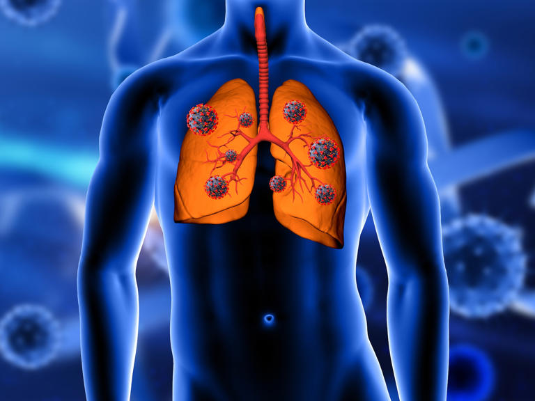 Types of Lung Disease and How They Disrupt the Way We Breathe