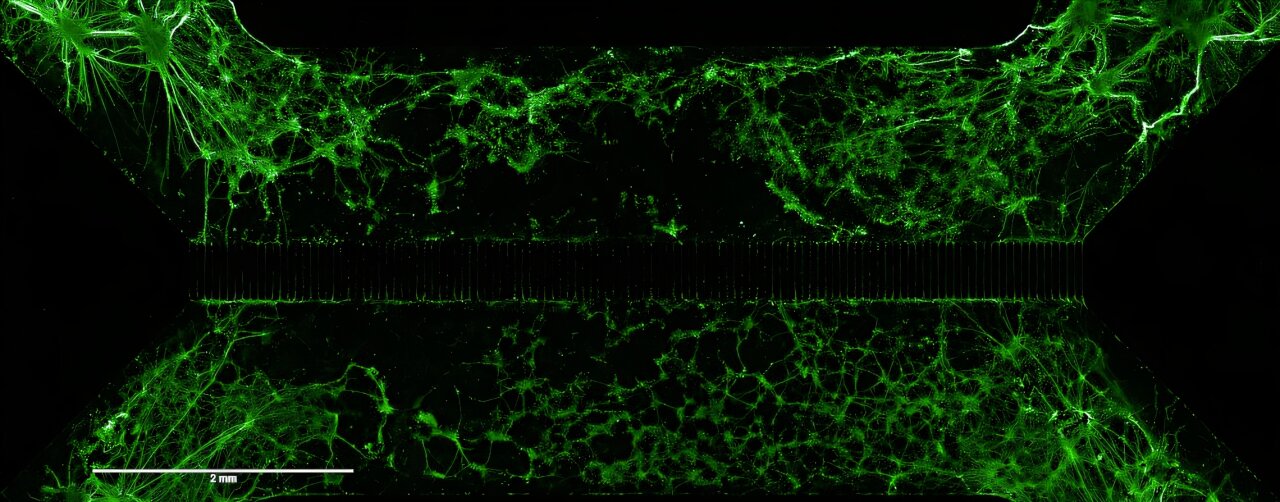 How stem cell therapy can regenerate brain tissue after a stroke
