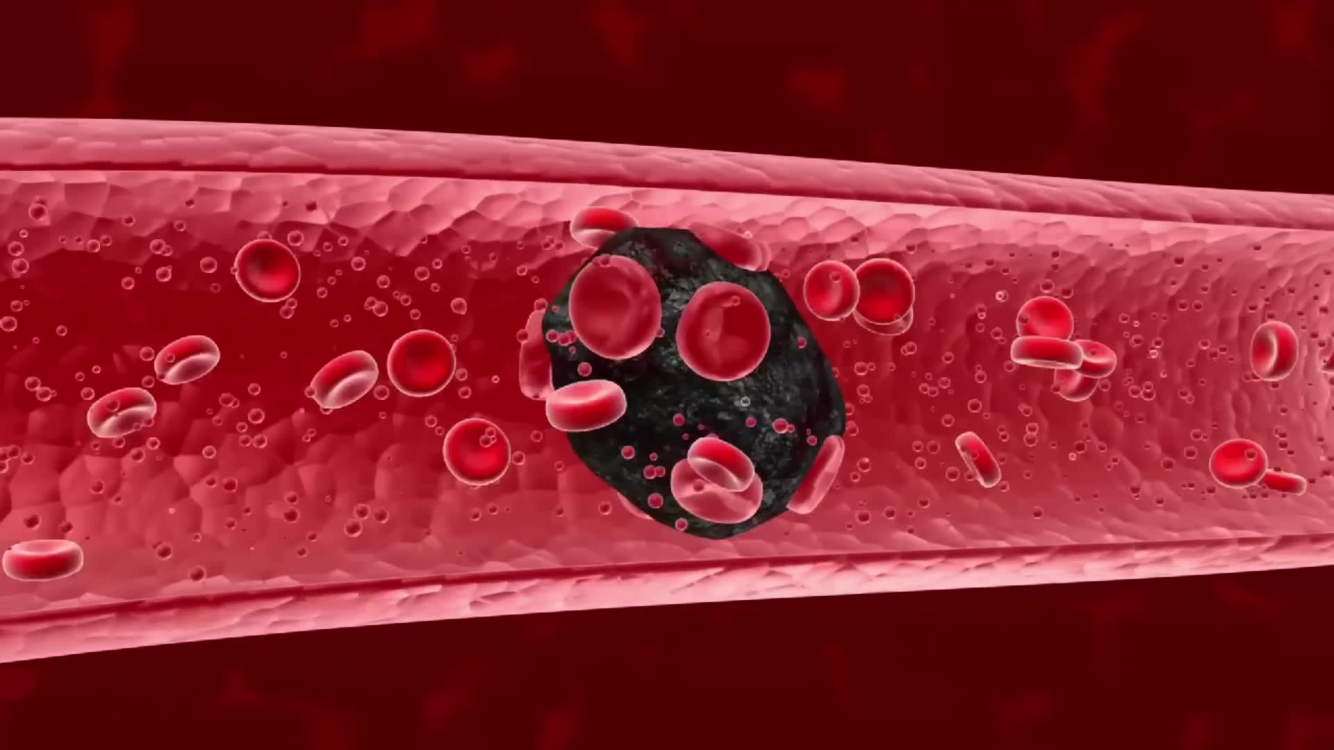 Deep vein thrombosis warning signs: recognizing dangerous blood clots before complications