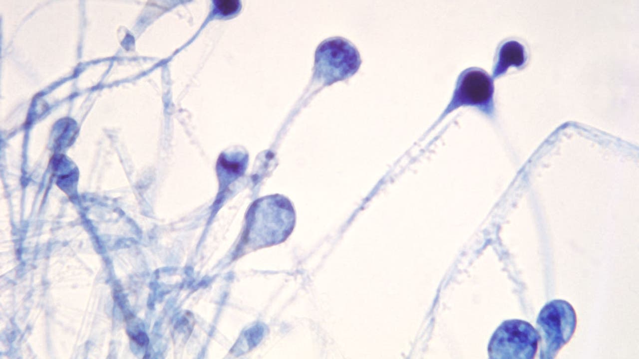 Seattle's Harborview investigating after 6 patients get rare fungal ...