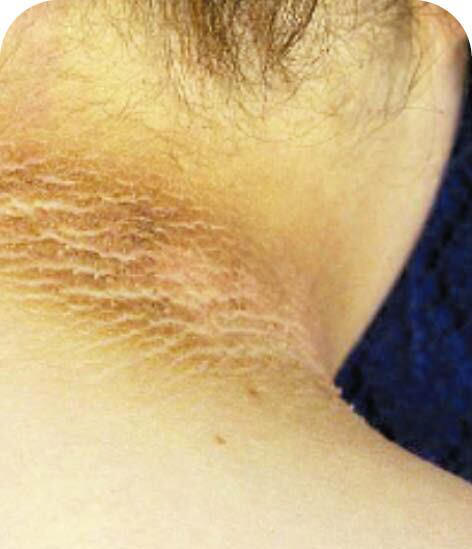 Earlobe crease, baldness signal health risks