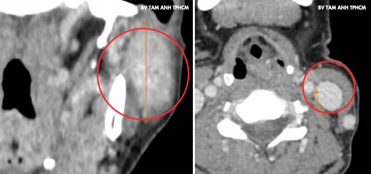 U ung thư tuyến mang tai xâm lấn dây thần kinh người phụ nữ