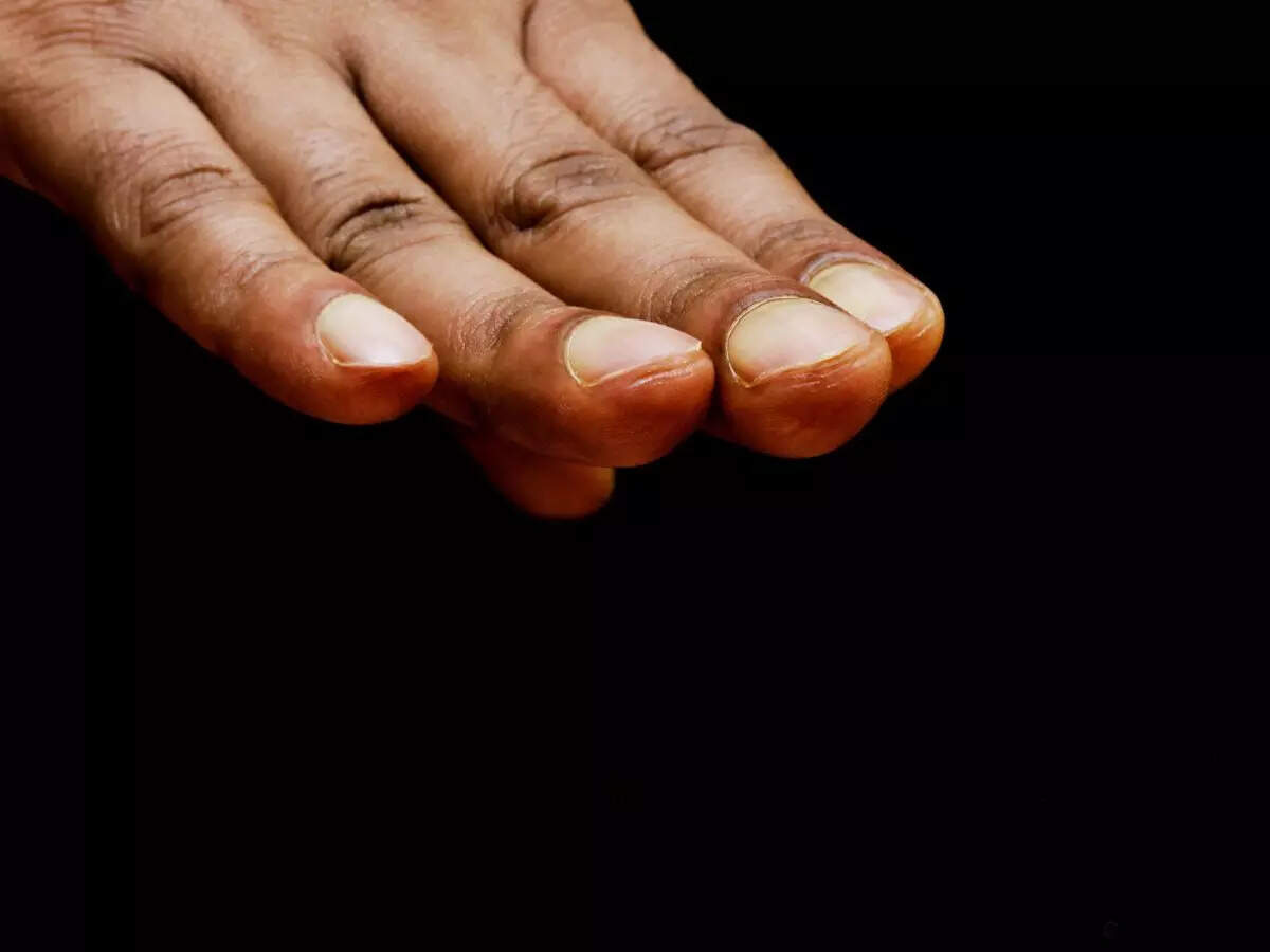 Vital organ malfunction? 5 nail signs that can save your life, just ...
