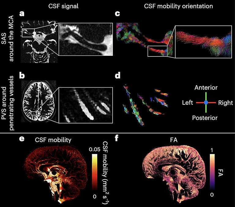 Cerebrospinal fluid motion in the brain captured in remarkable detail