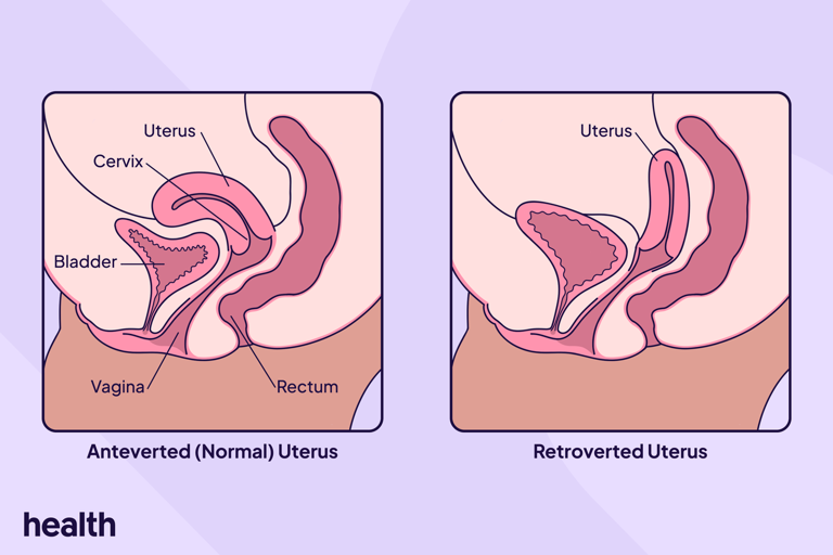What to know about a retroverted uterus (tilted uterus)
