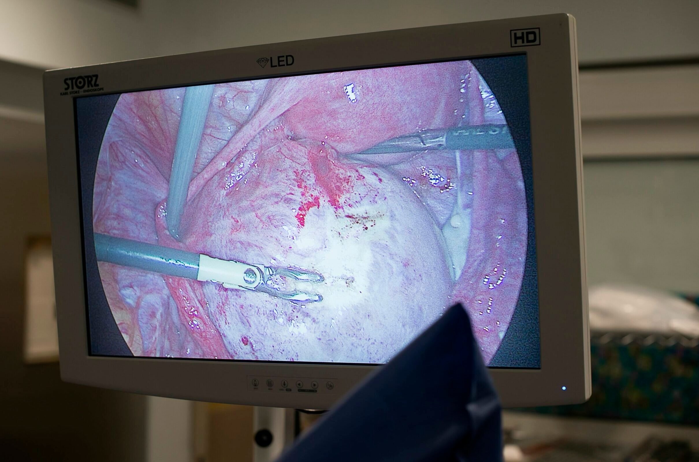 How I knew I had endometriosis: One woman’s years-long journey to a ...