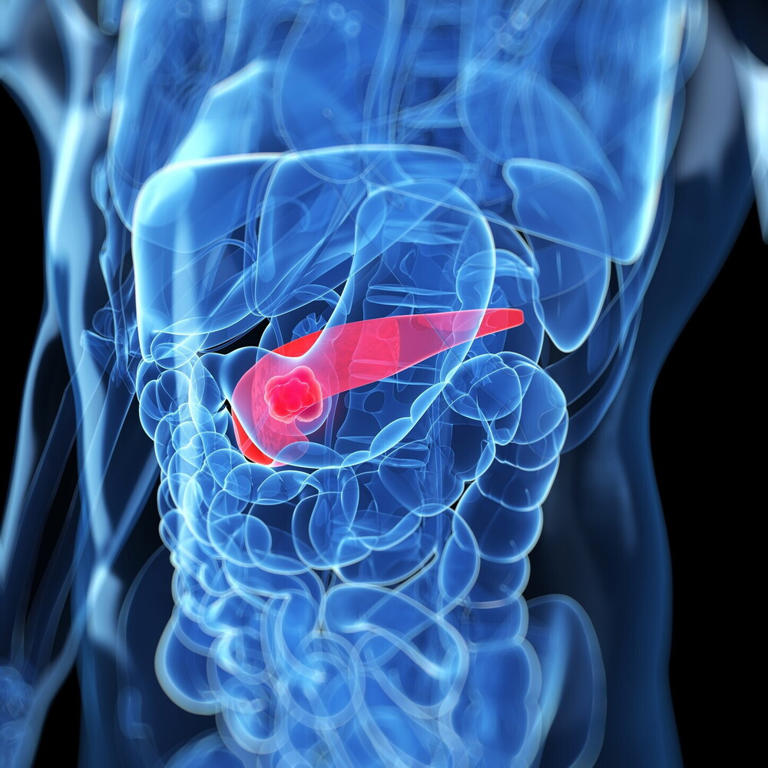 Tumori: +10% di pazienti vivi dopo una diagnosi di cancro al pancreas