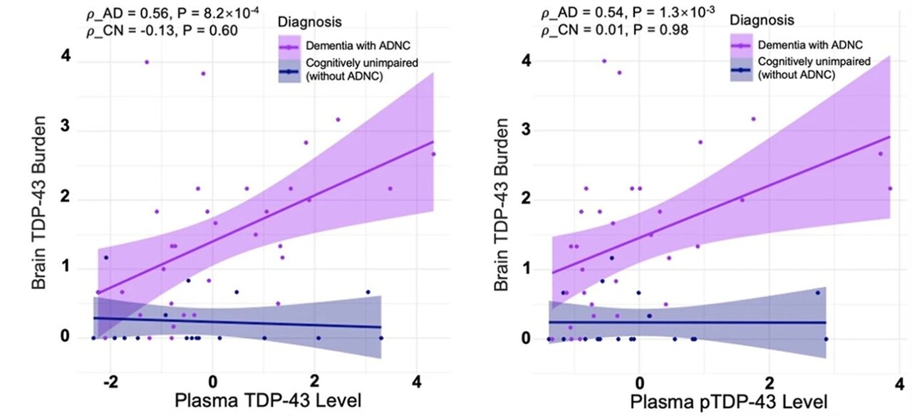 Simple blood test may someday allow for diagnosis of LATE dementia ...
