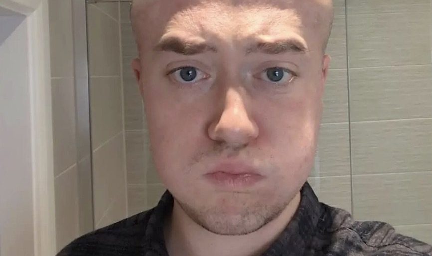 Balding man says he was left ‘looking like Megamind’ after hair transplant