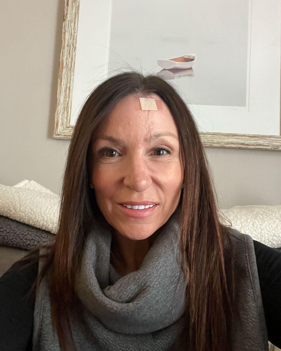 I Lost My Nose to a Dog Bite. 4 Surgeries Later, I Finally Looked Like ...