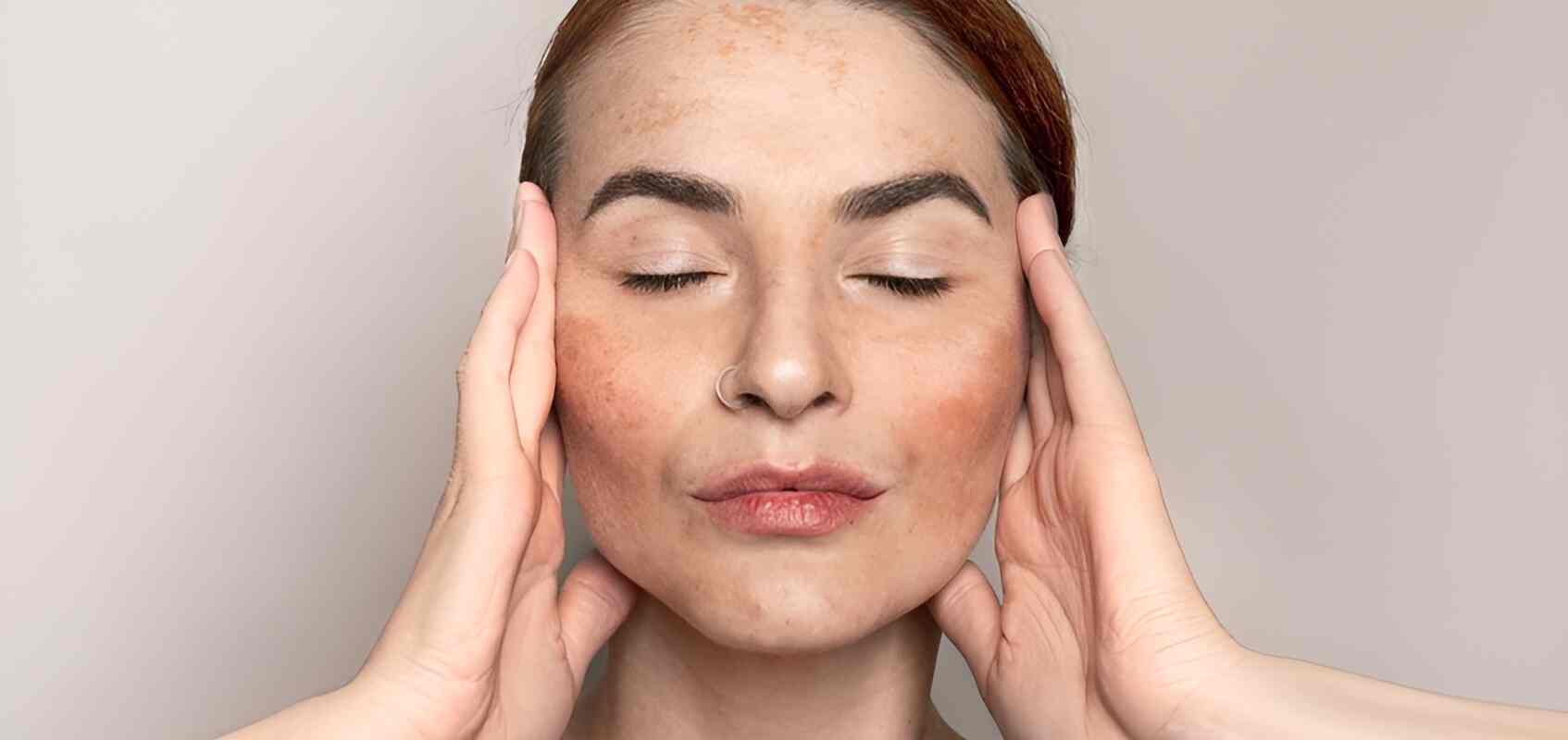 Melasma Pigmentation Through the Ages: From 20s Hormones to 50s Sun Spots