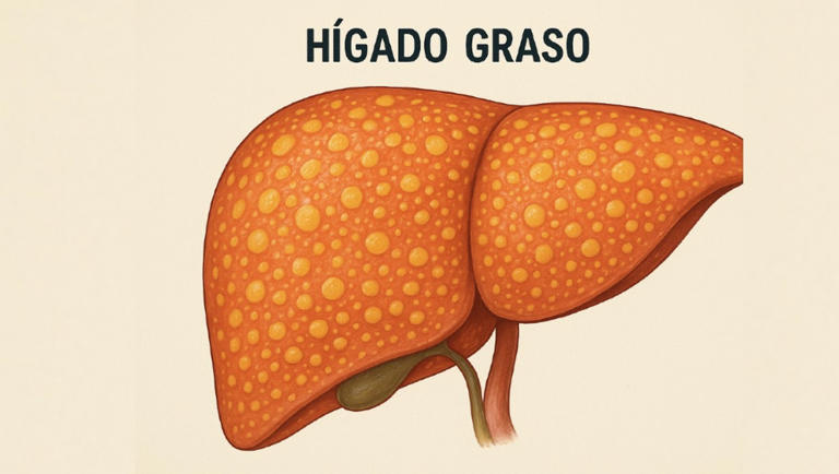 Hígado graso: hasta cuándo es posible revertir el daño antes de que sea ...