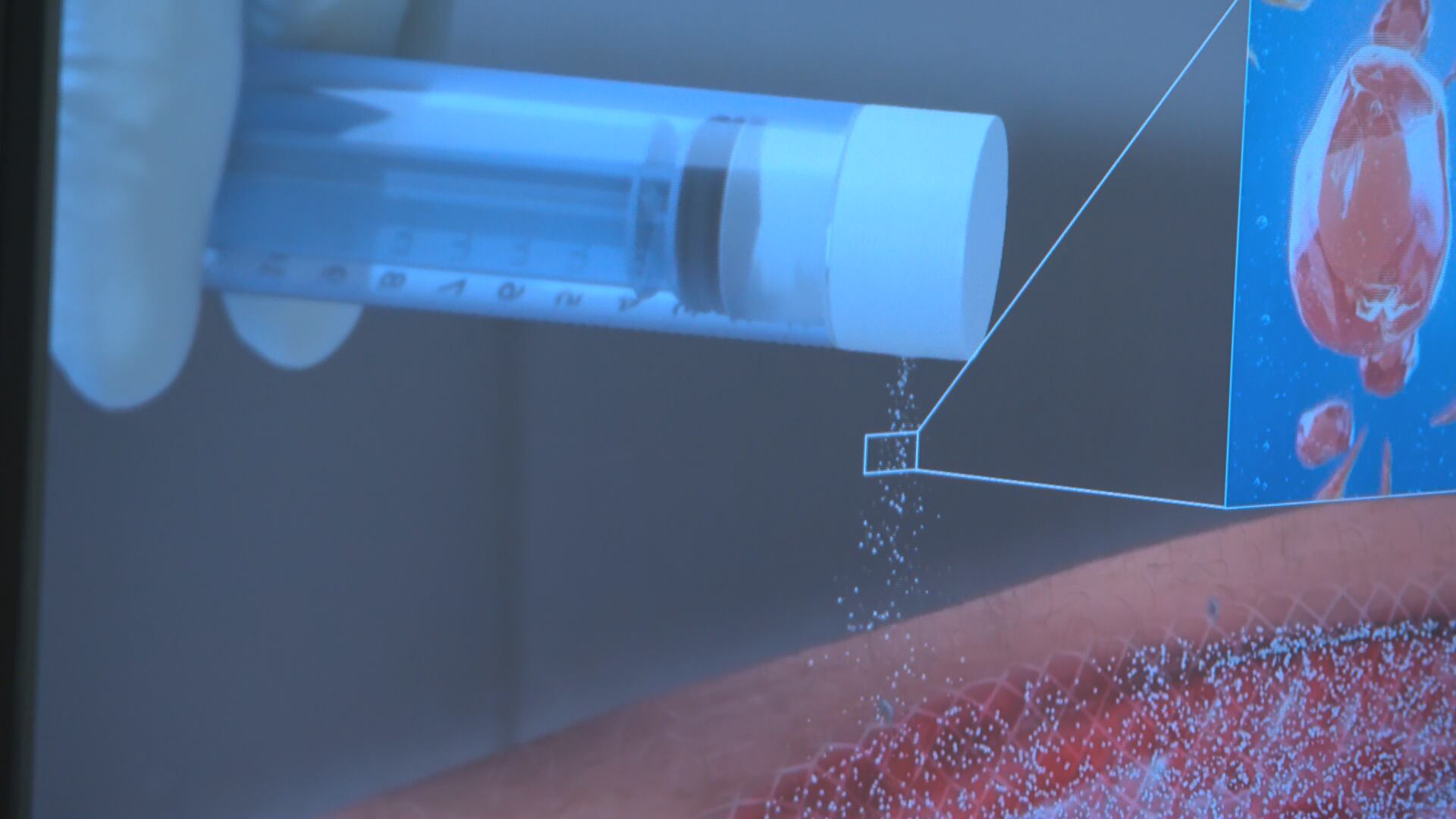 Burn surgeons use spray-on skin technology for faster healing