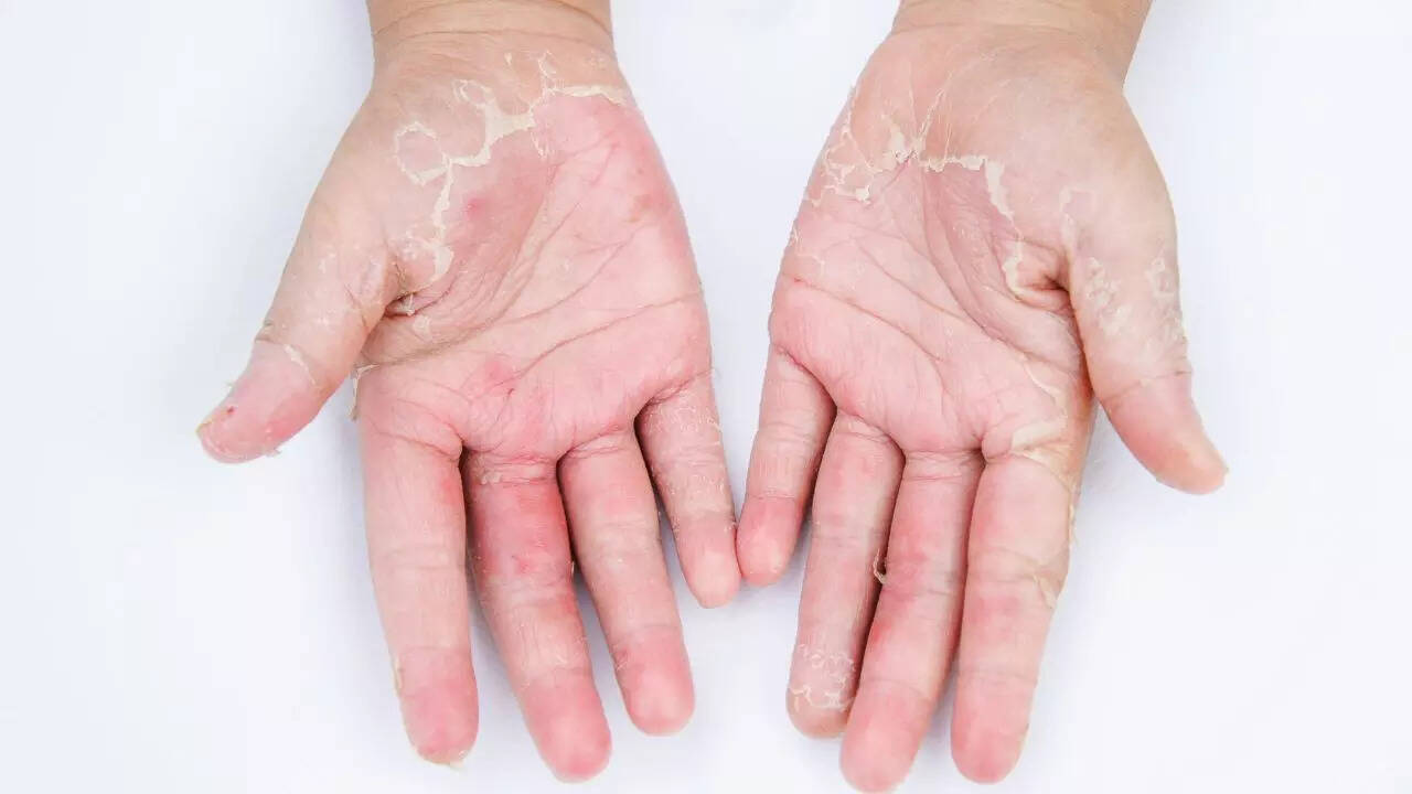 How to treat and prevent dry hands in winter