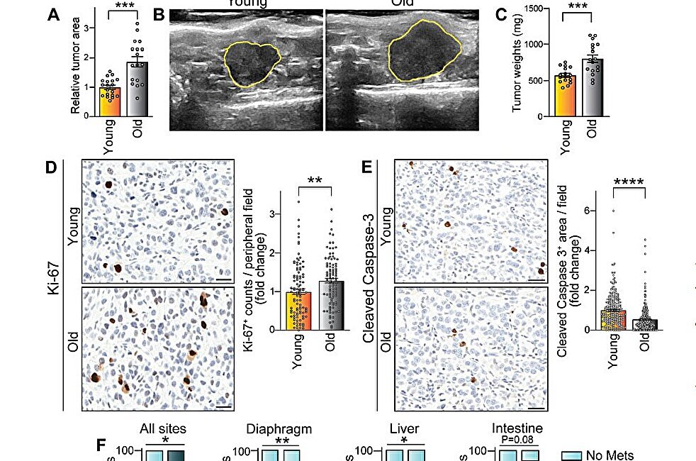 Factoring in frailty and age could improve pancreatic cancer treatment