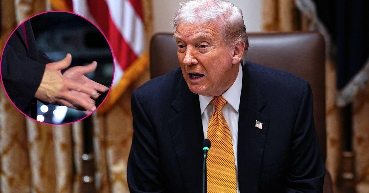 Donald Trump Seen With Obvious Makeup Over His Bruised Hand at ...