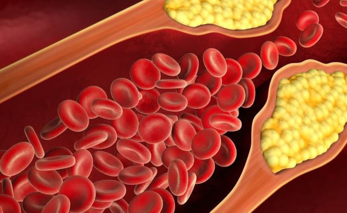 New Research On Gene Editing Therapy May Cut Cholesterol, Triglycerides ...