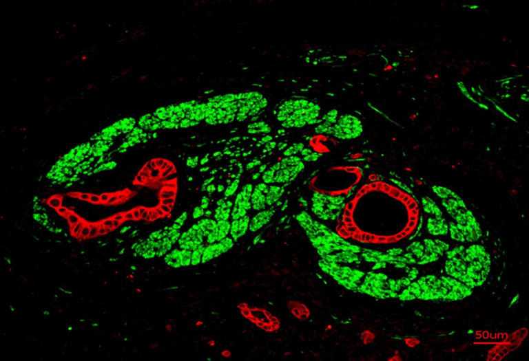 Pancreatic cancer forms 'synapses,' scientists discover