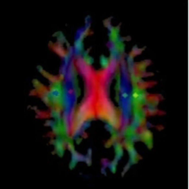 Following anti-amyloid therapy, MRI shows no short-term change in waste ...