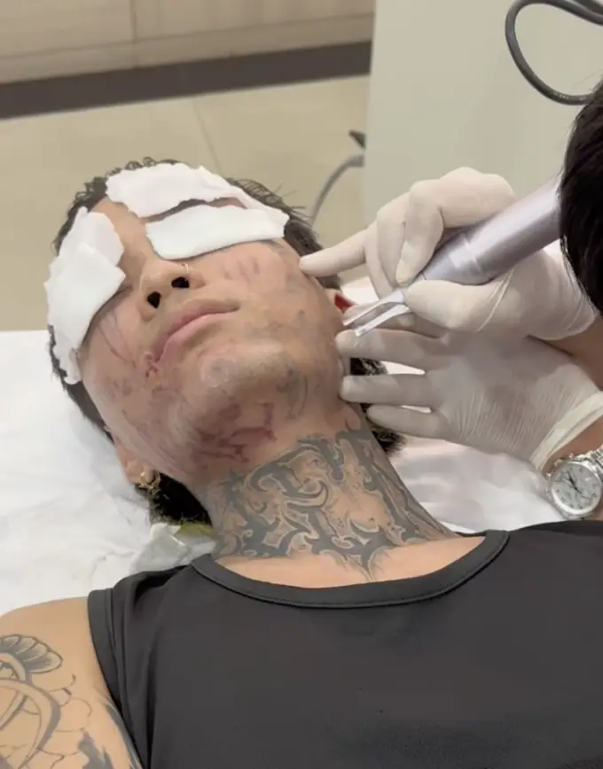 Man ‘burns’ face 8 times to remove tattoos