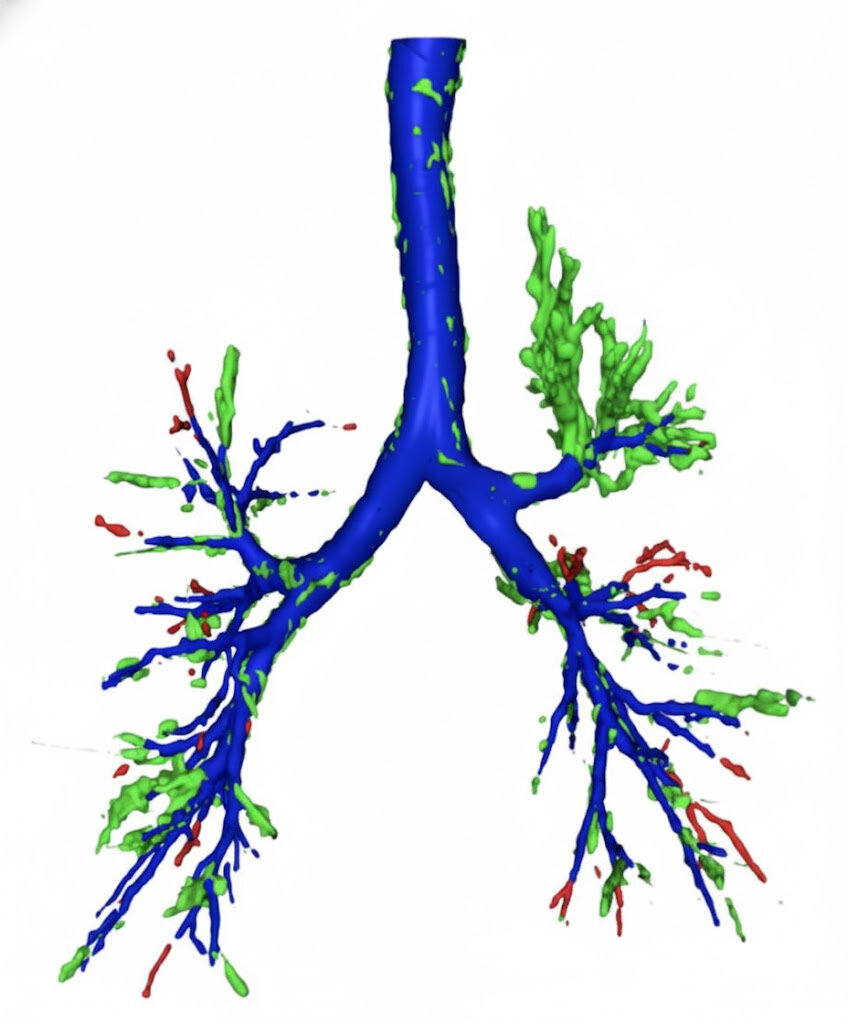 AI detects hidden objects on chest scans better than radiologists