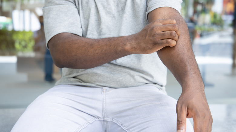 Ringworm Explained: Causes, Symptoms, And Treatments