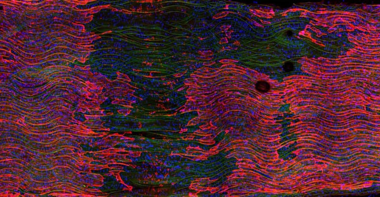 Protein found to be key in blood vessel healing after surgical injury