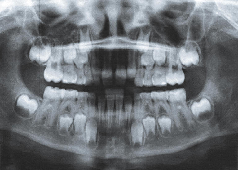 A Dental Gel Can Regenerate Enamel and Remove Cavities. What to Know