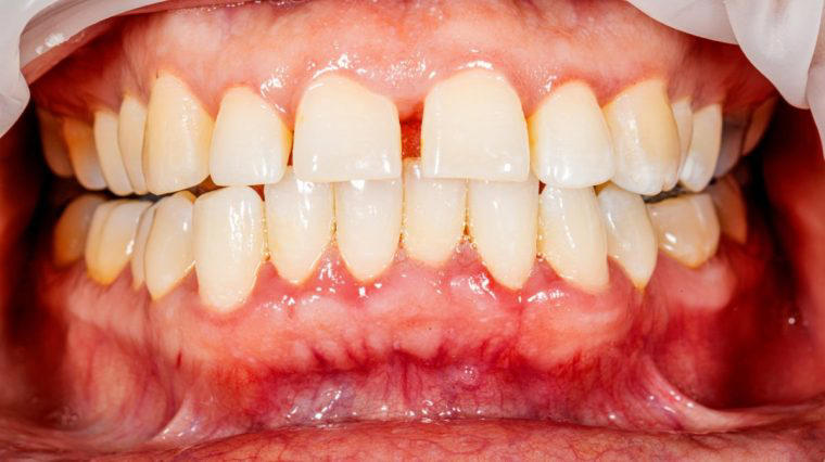 For decades I didn’t bother to floss – now, at 50, my teeth are falling out