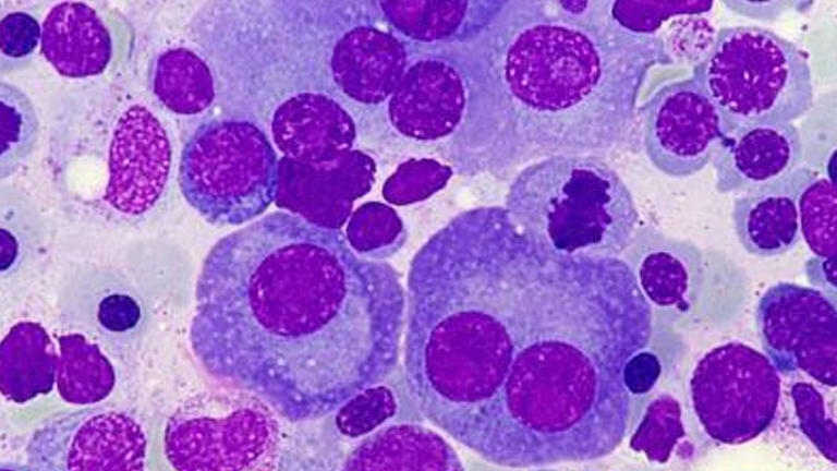 Daratumumab: la nueva alternativa para el mieloma múltiple