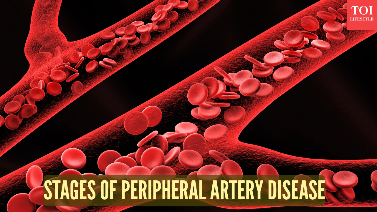 4 stages of peripheral artery disease: From mild circulation issues to ...