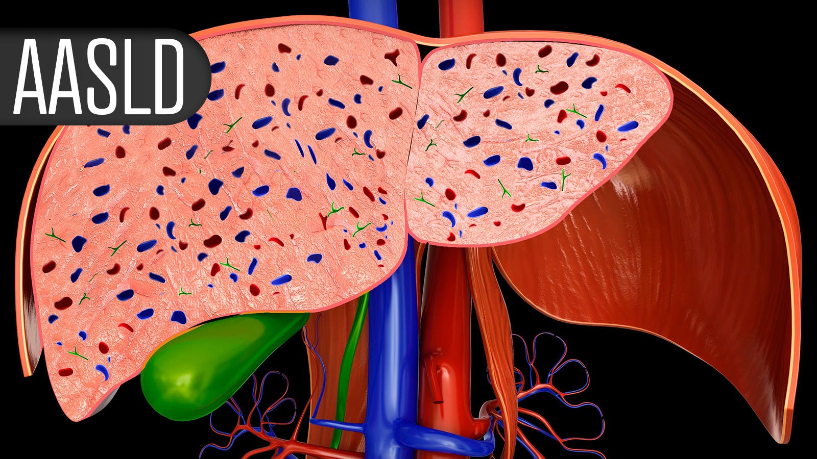 After Hepatitis C Cure, MASLD May Boost Liver Cancer Risk