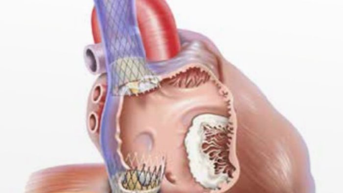 Impianto percutaneo valvola tricuspide: primo a Benevento al ...