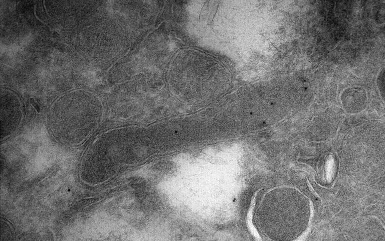 New study finds bacteria in brain tumors play ‘surprising’ role in ...