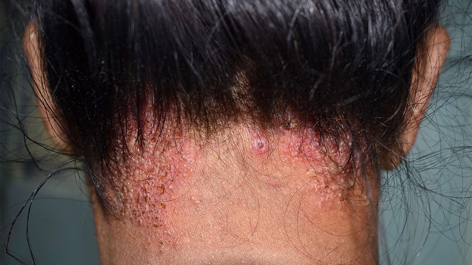 Common Skin Condition Tied to Wide Range of Epithelial Barrier Diseases