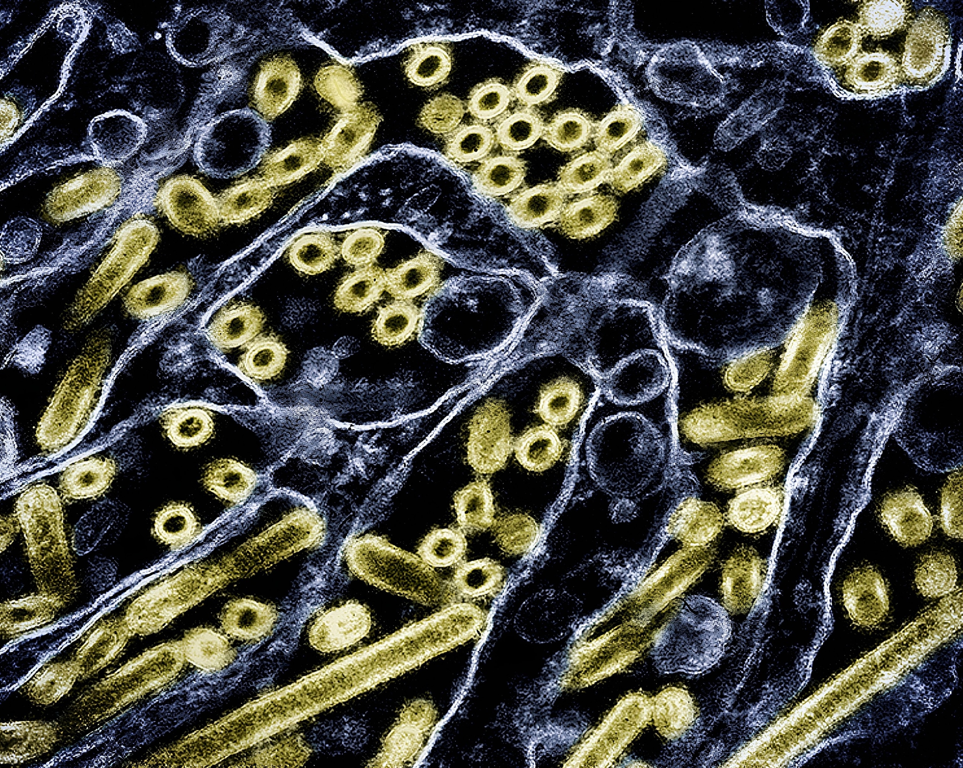 Bird flu strain confirmed in human for 1st time after only seen in ...
