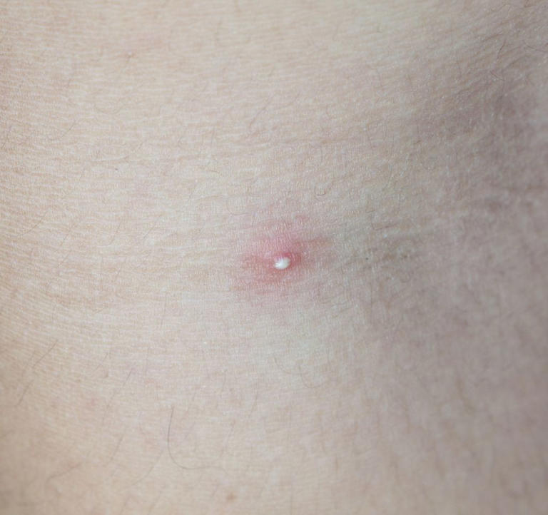 Different types of pimples and how to tackle them