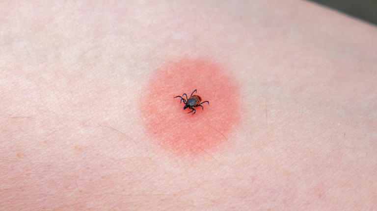 When You Get Bitten By A Tick, Here's What Could Happen To Your Body