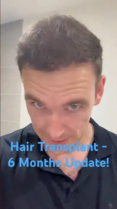 6 month hair transplant update with elithair