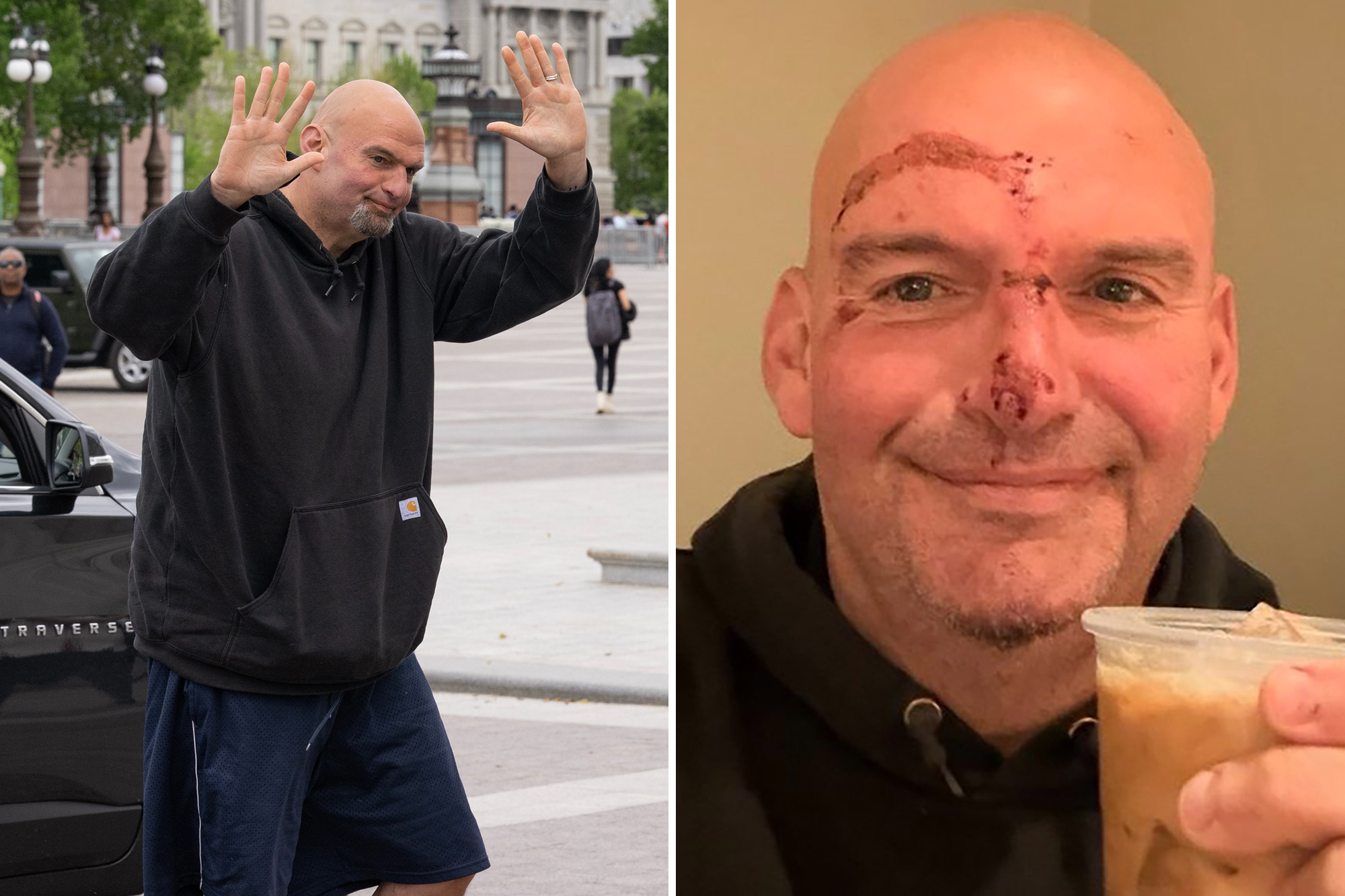 Sen. John Fetterman shares gnarly photo of bloodied face as he’s ...