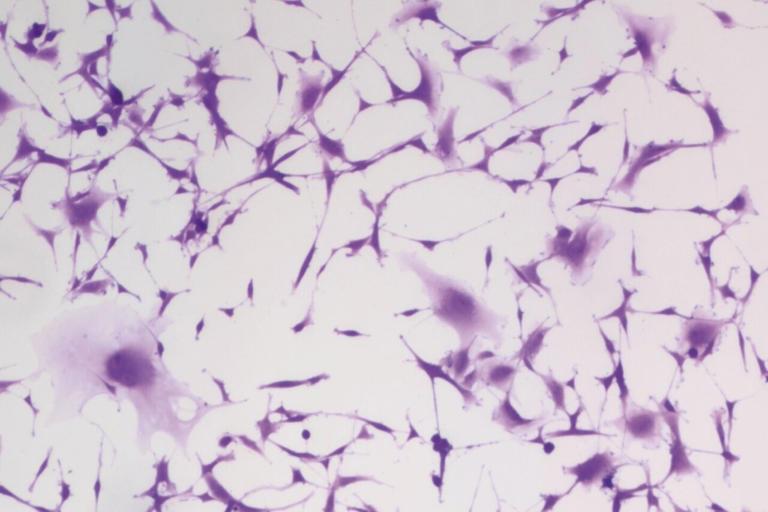 One of the world's oldest blood pressure drugs may also halt aggressive ...