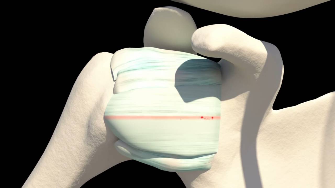 Understanding frozen shoulder syndrome: what causes it and proven ...