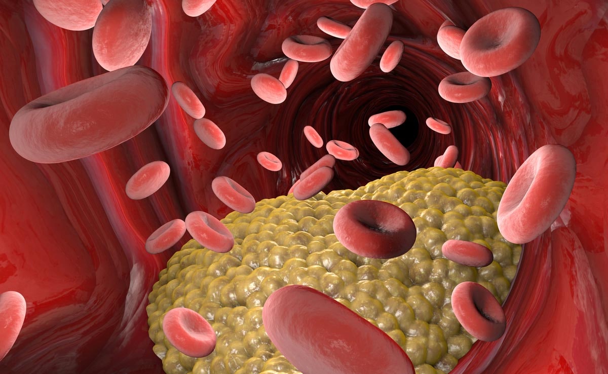 Why do some people require blood thinners in winter for optimal heart ...