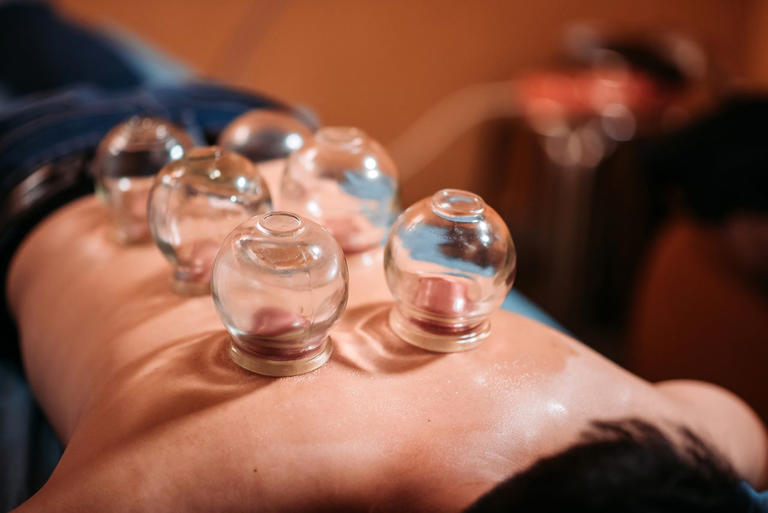 Cupping Therapy: What You Should Know