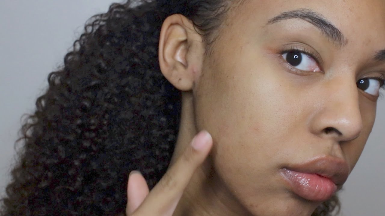 Overnight clear skin: My natural acne & scar routine revealed!