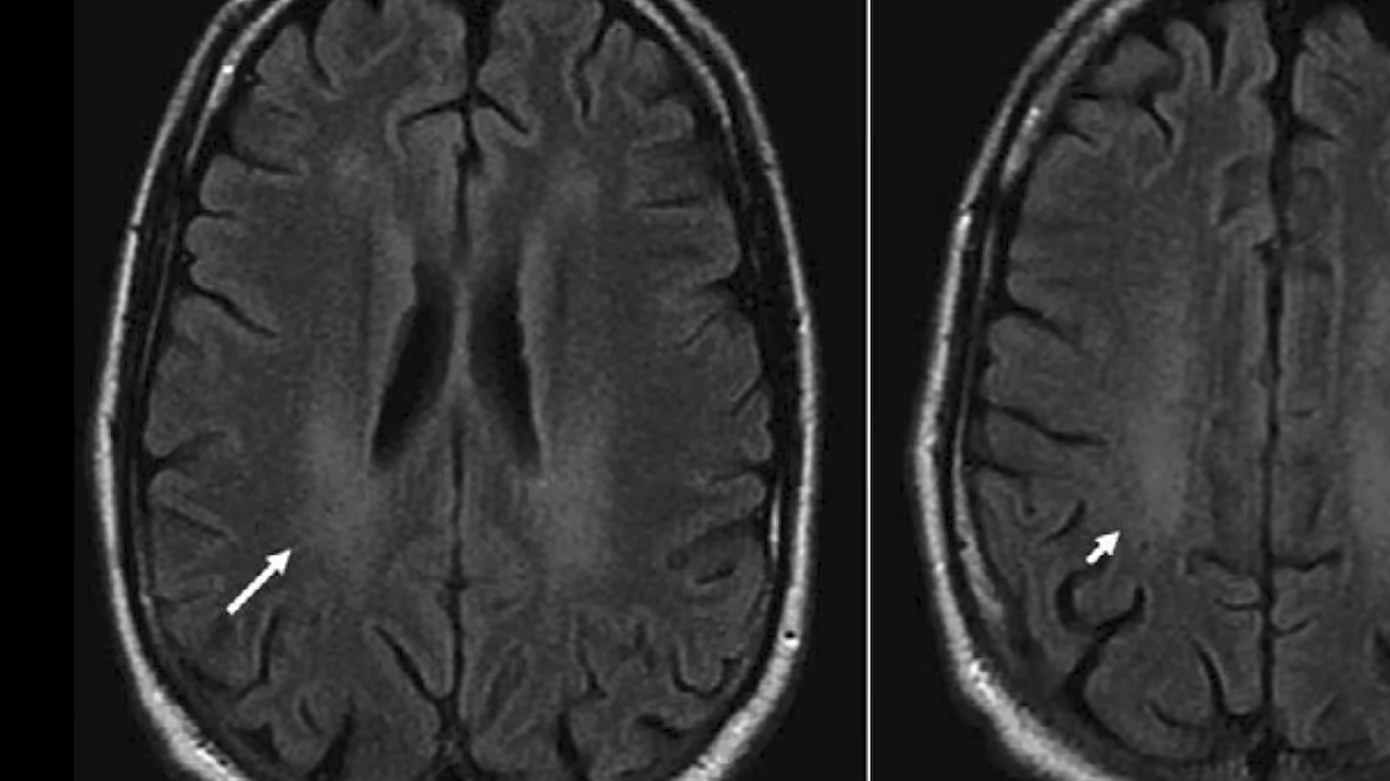 21-year-old suffers brain damage from popular diet